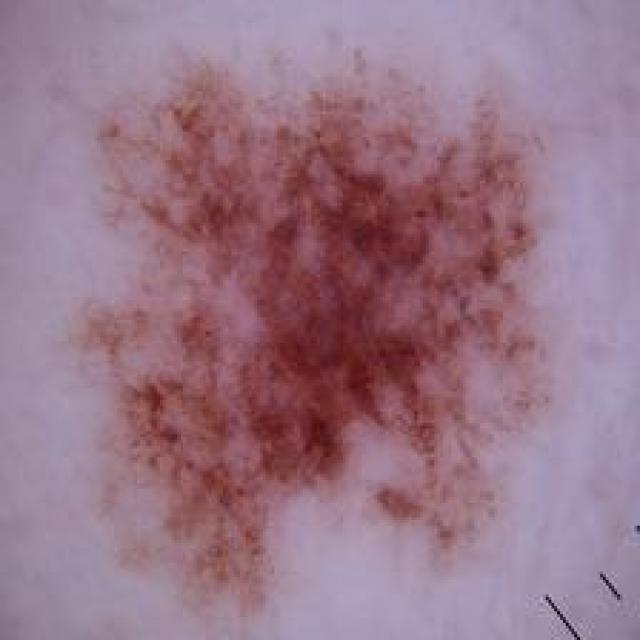 Skin Cancer Object Detection Dataset By Freelance