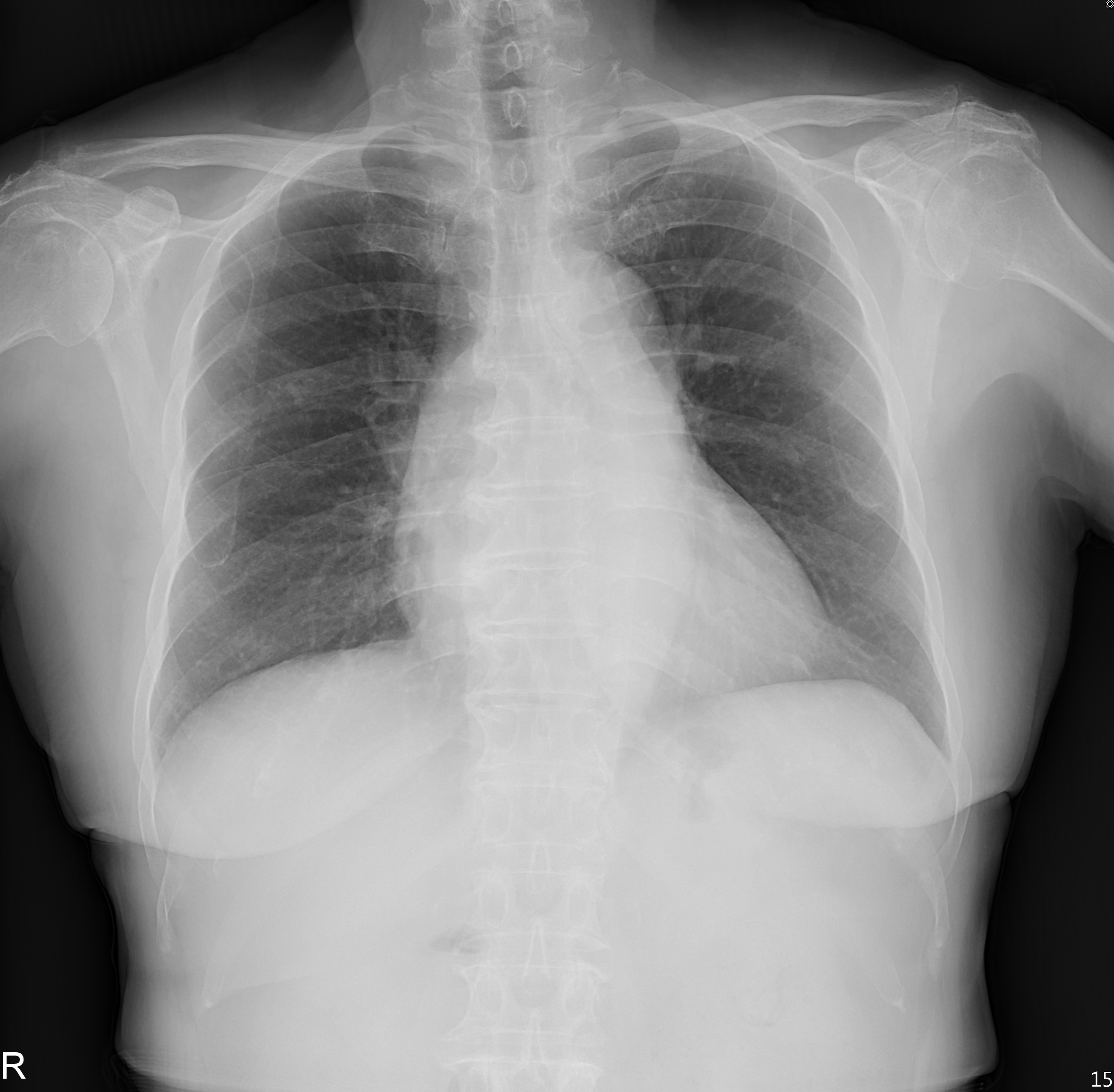 lung_x-ray_detection Object Detection Model by naso