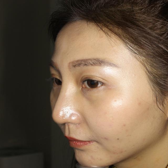 Acne Object Detection Object Detection Dataset And Pre Trained Model By