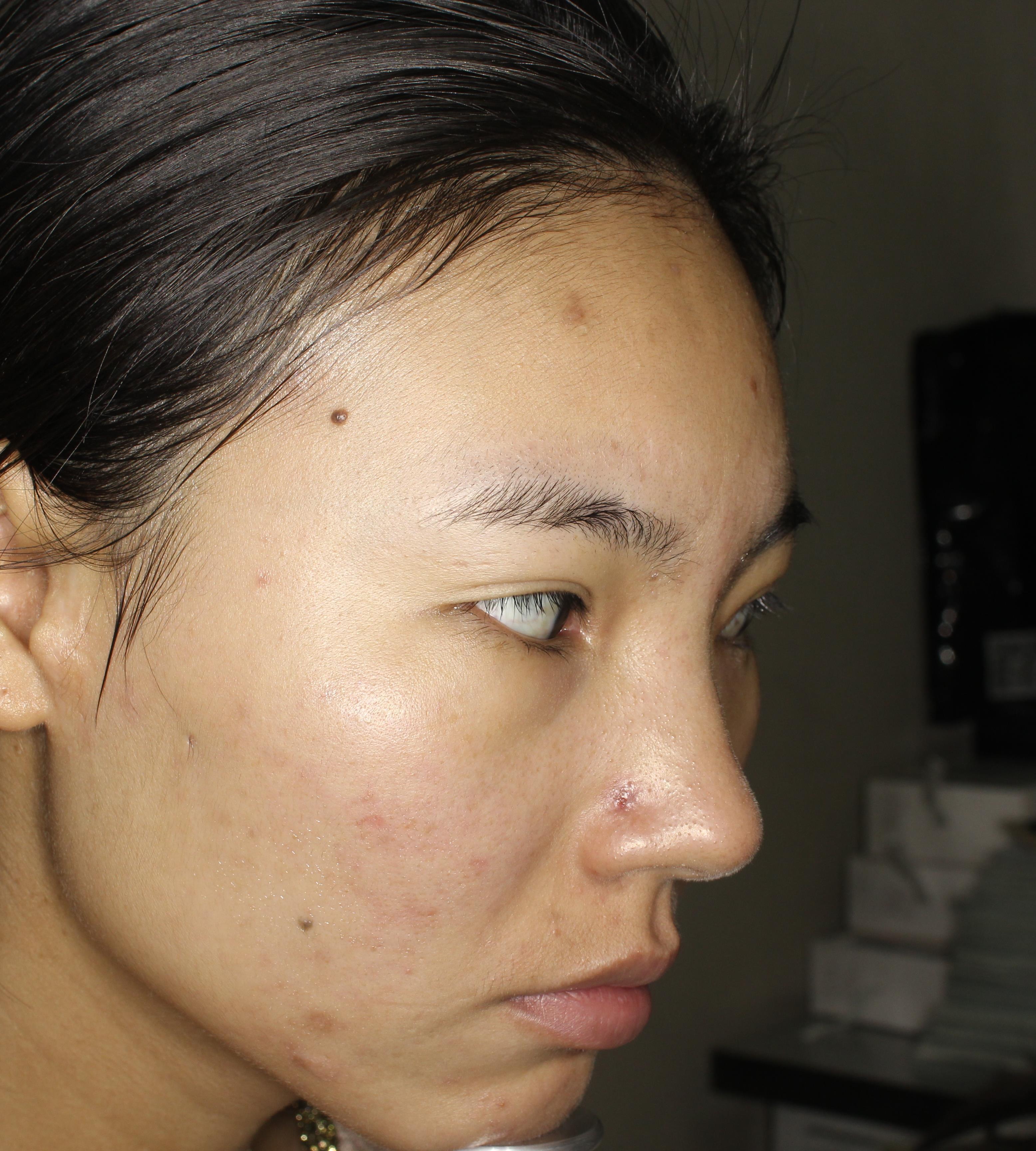 acne-kbm0q Object Detection Dataset and Pre-Trained Model by acnejvorn