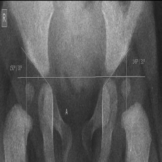 ddh-seg Instance Segmentation Dataset and Pre-Trained Model by ddh