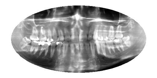 Dental-Radiography Object Detection Dataset and Pre-Trained Model by opg