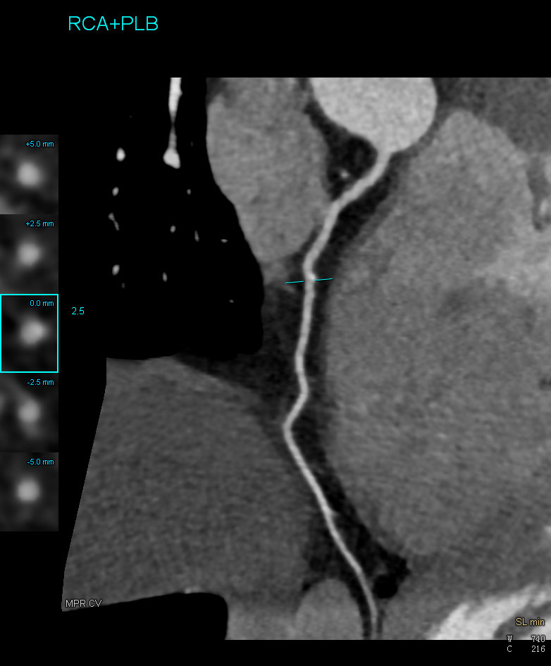 Heart Vessel Detection Object Detection Dataset By Cobra