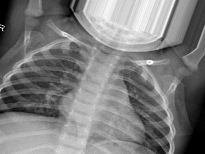 lung_disease_detection Object Detection Model by lungdiseasedetection