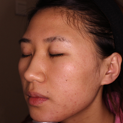 Facial Skin Monitoring Object Detection Model by facial skin monitoring