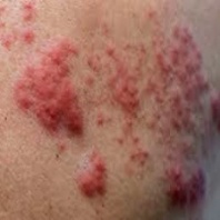 Fungal infection detection Object Detection Dataset by Harshit Jain