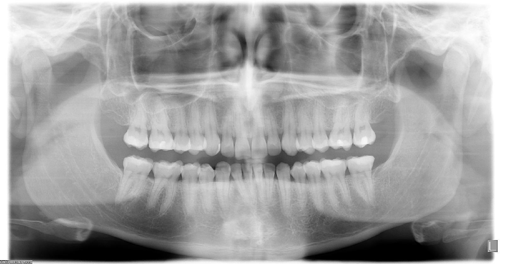 1k opg images Object Detection Dataset by sinus