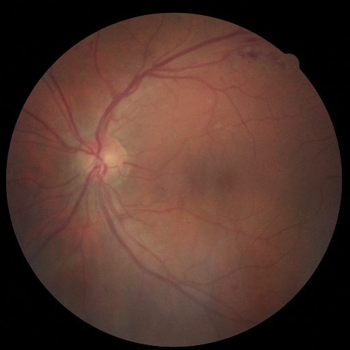 Detect_Opht_Diseases Object Detection Dataset by Marmara University