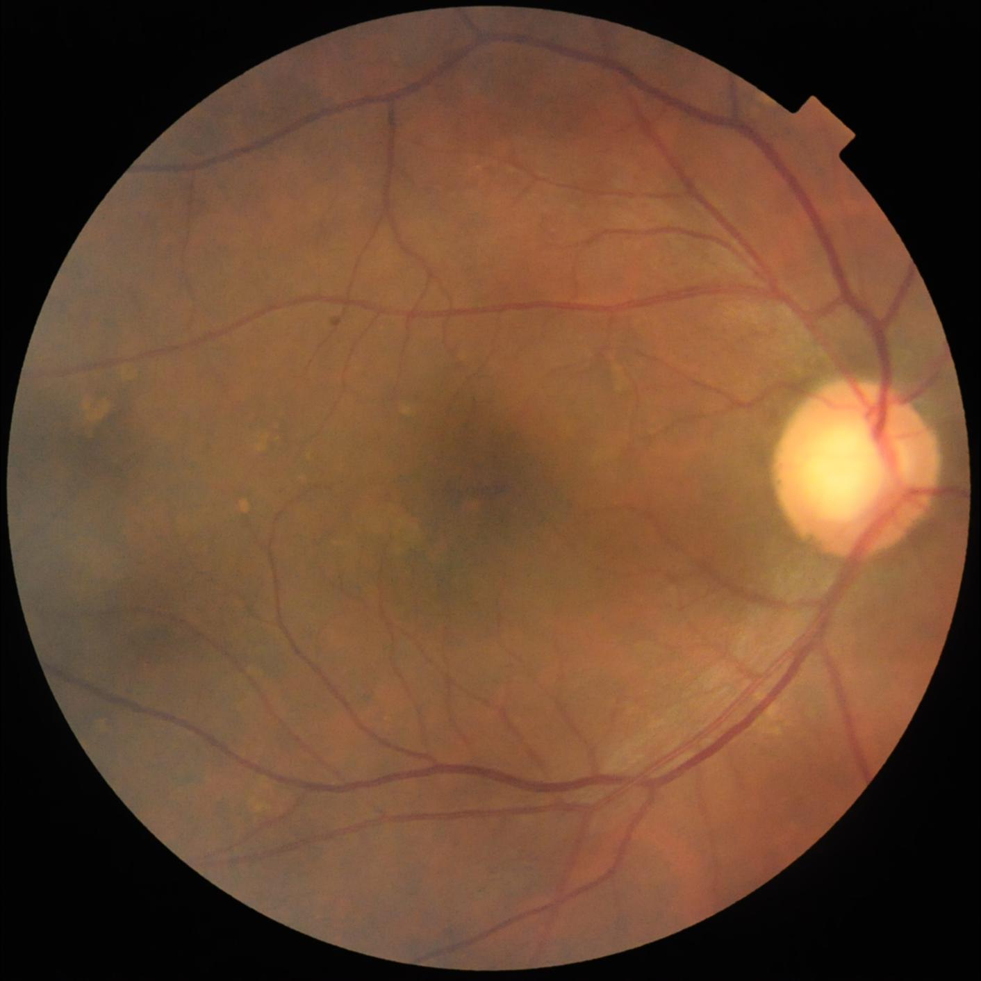 drusen_segmentation Instance Segmentation Dataset by AI