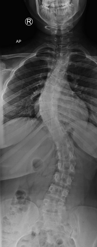 Spine Region Object Detection Dataset by xray keypoint