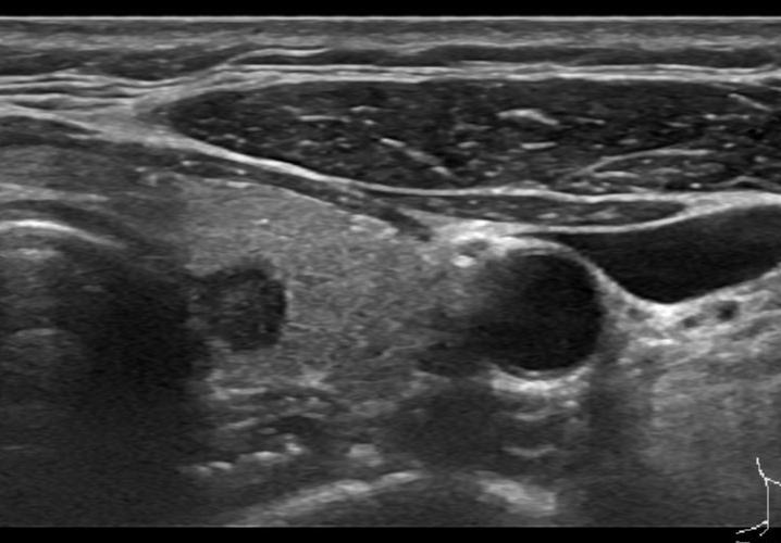 Thyroid TR Classification Classification Dataset by Bharath Gaddam