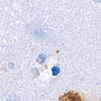 Plaque detection - Roboflow Universe