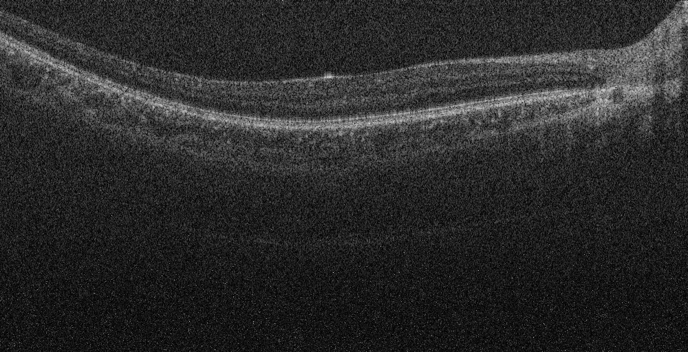 retinal_layer_segmentation Instance Segmentation Model by gxr
