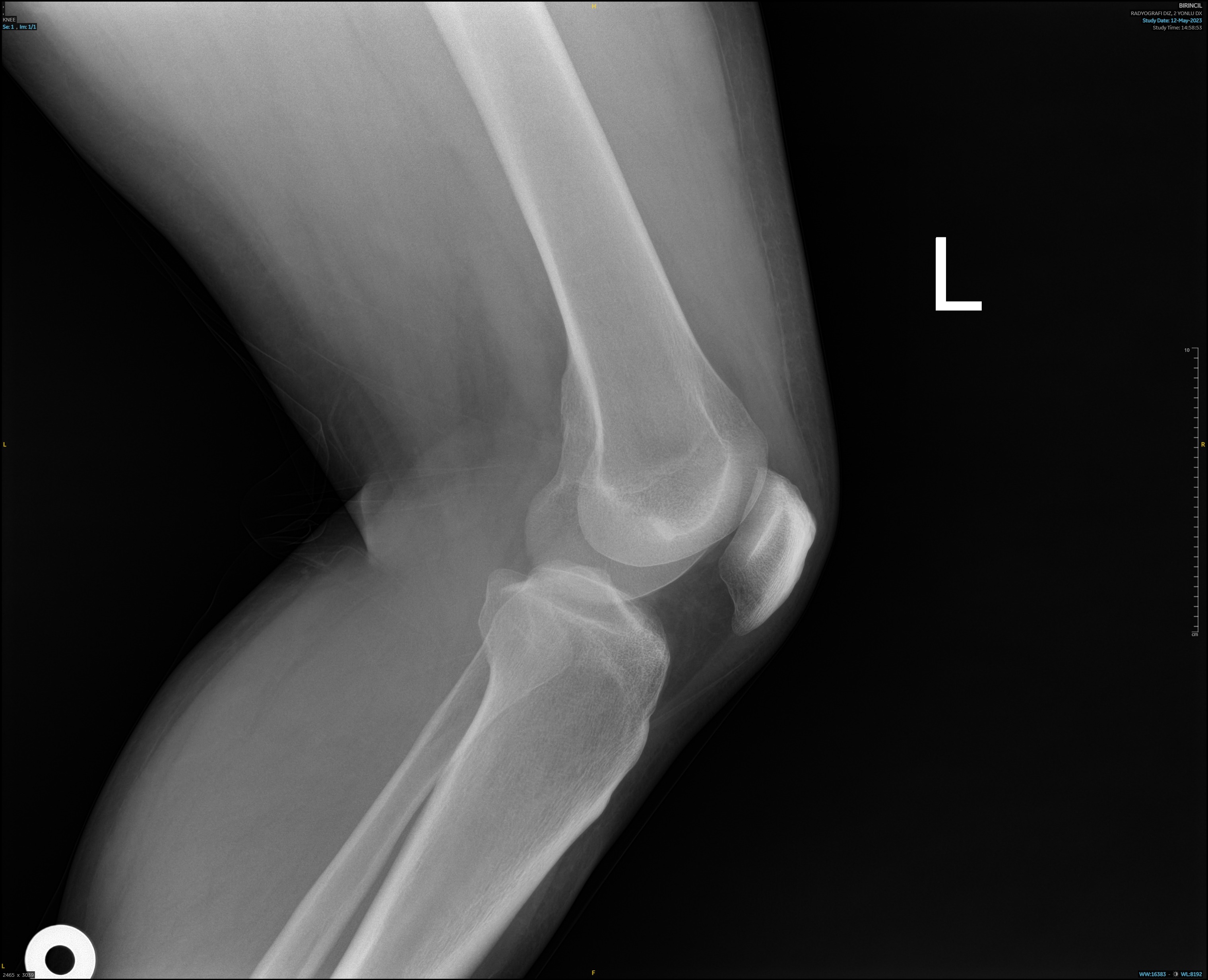 Knee Lateral Graphy Instance Segmentation Model by ELECTROMTECH