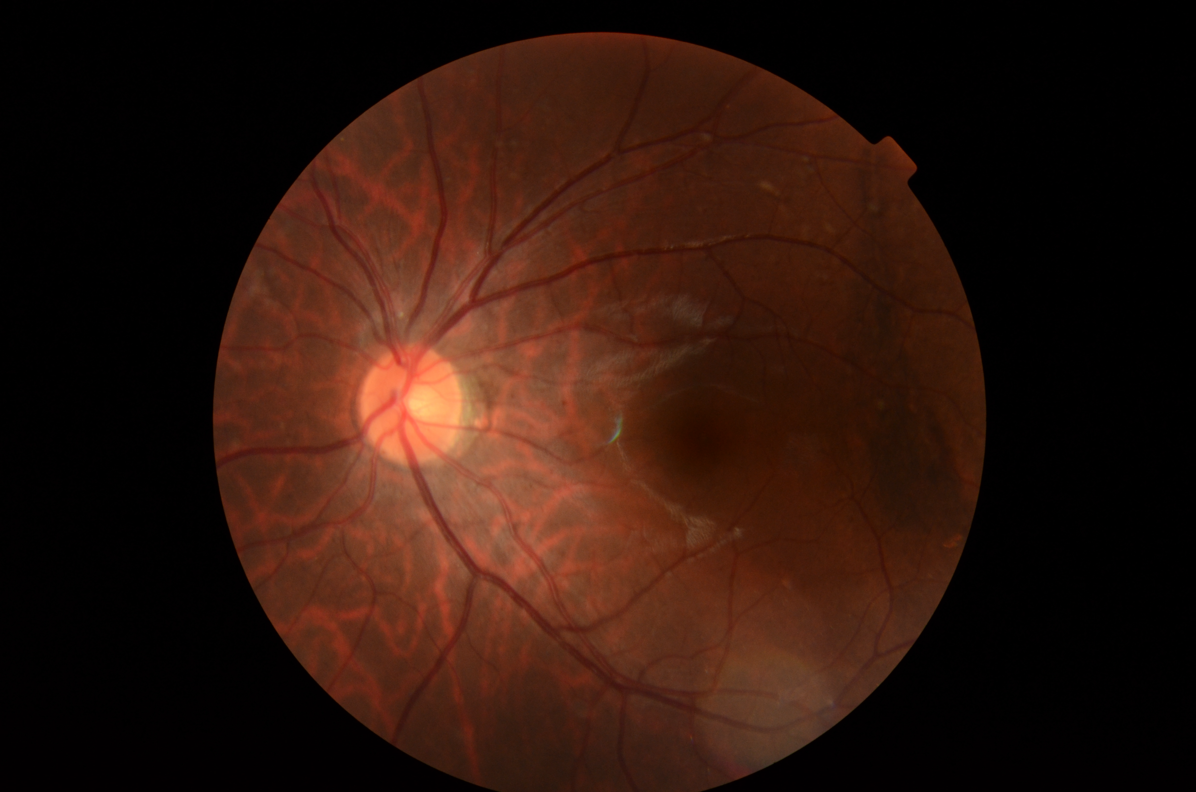 cataract Object Detection Dataset by Falguni Suryawanshi