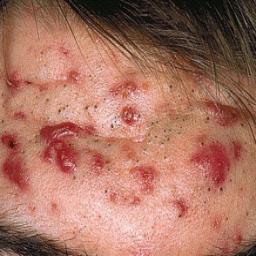 acne yolo Object Detection Dataset and Pre-Trained Model by acne