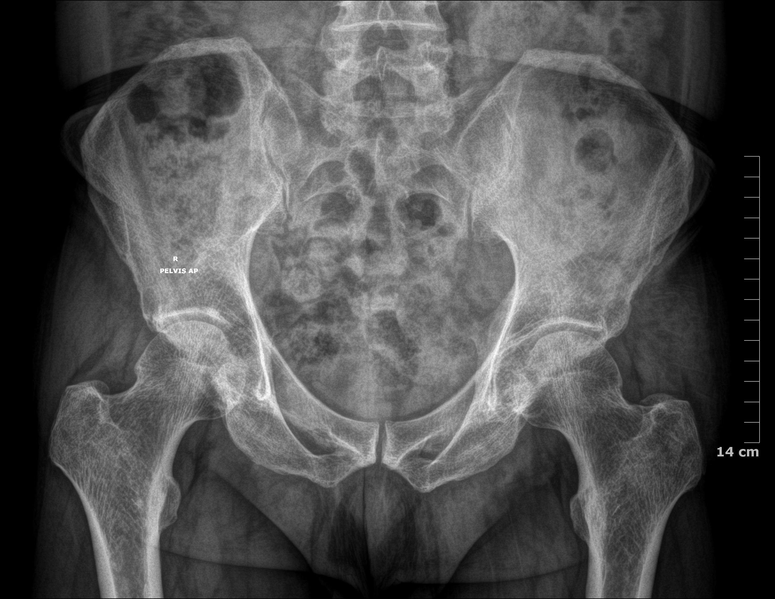 PoC_Hip_Segmentation_notFemur Instance Segmentation Dataset by Rohan