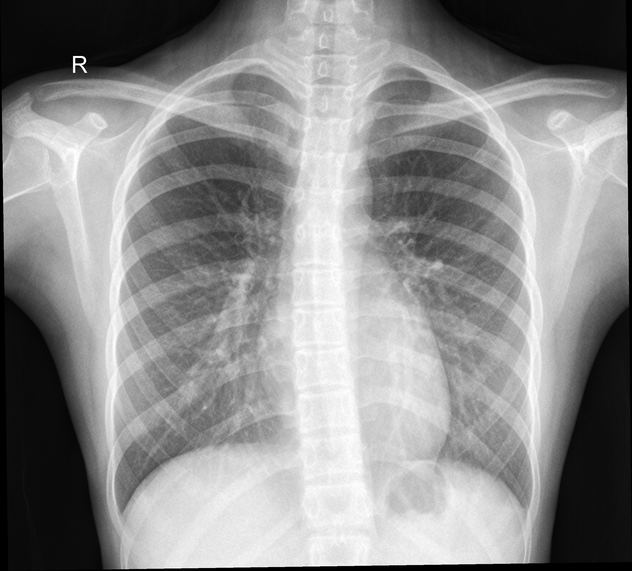 classification of pneumonia patients Classification Dataset by NUST