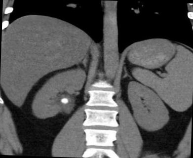 Kidney Stone Detection Instance Segmentation Dataset by marychaes workplace