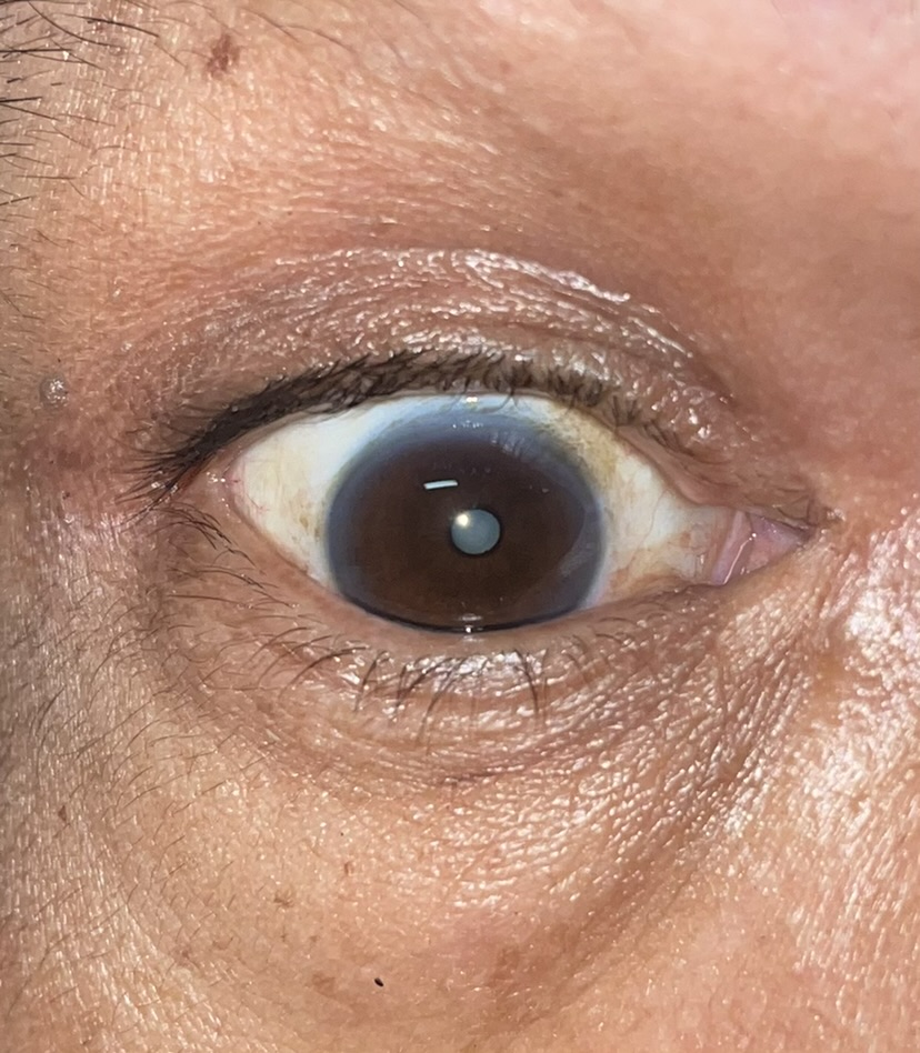 Cataract-Sardjito-Pupil Object Detection Dataset by NewWorkspace