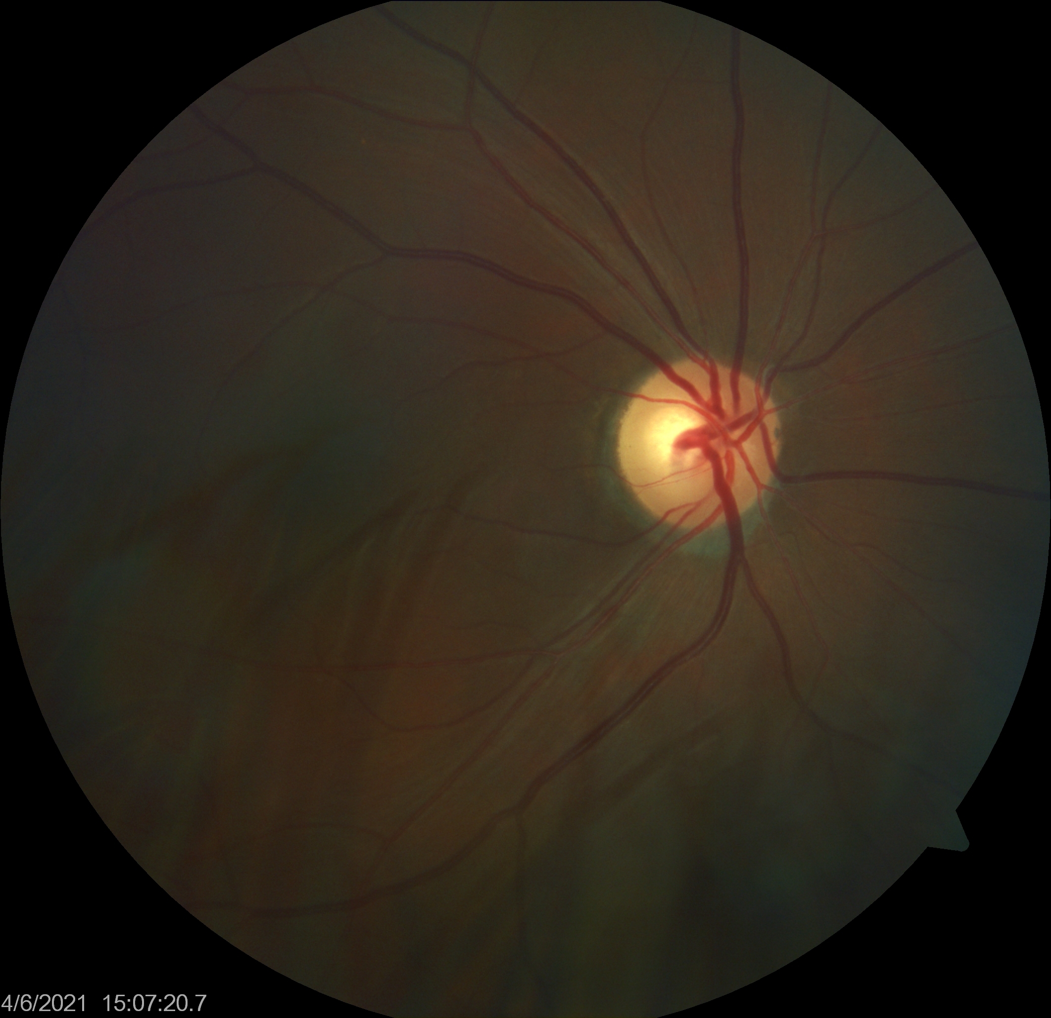 Glaucoma Object Detection Object Detection Dataset And Pre Trained Model By Newworkspace