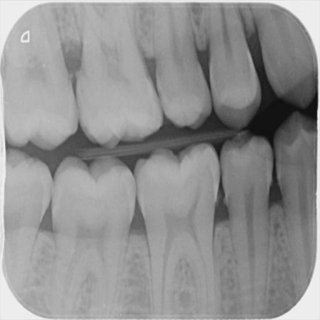 bitewing-sag_fold1 Instance Segmentation Dataset by TU