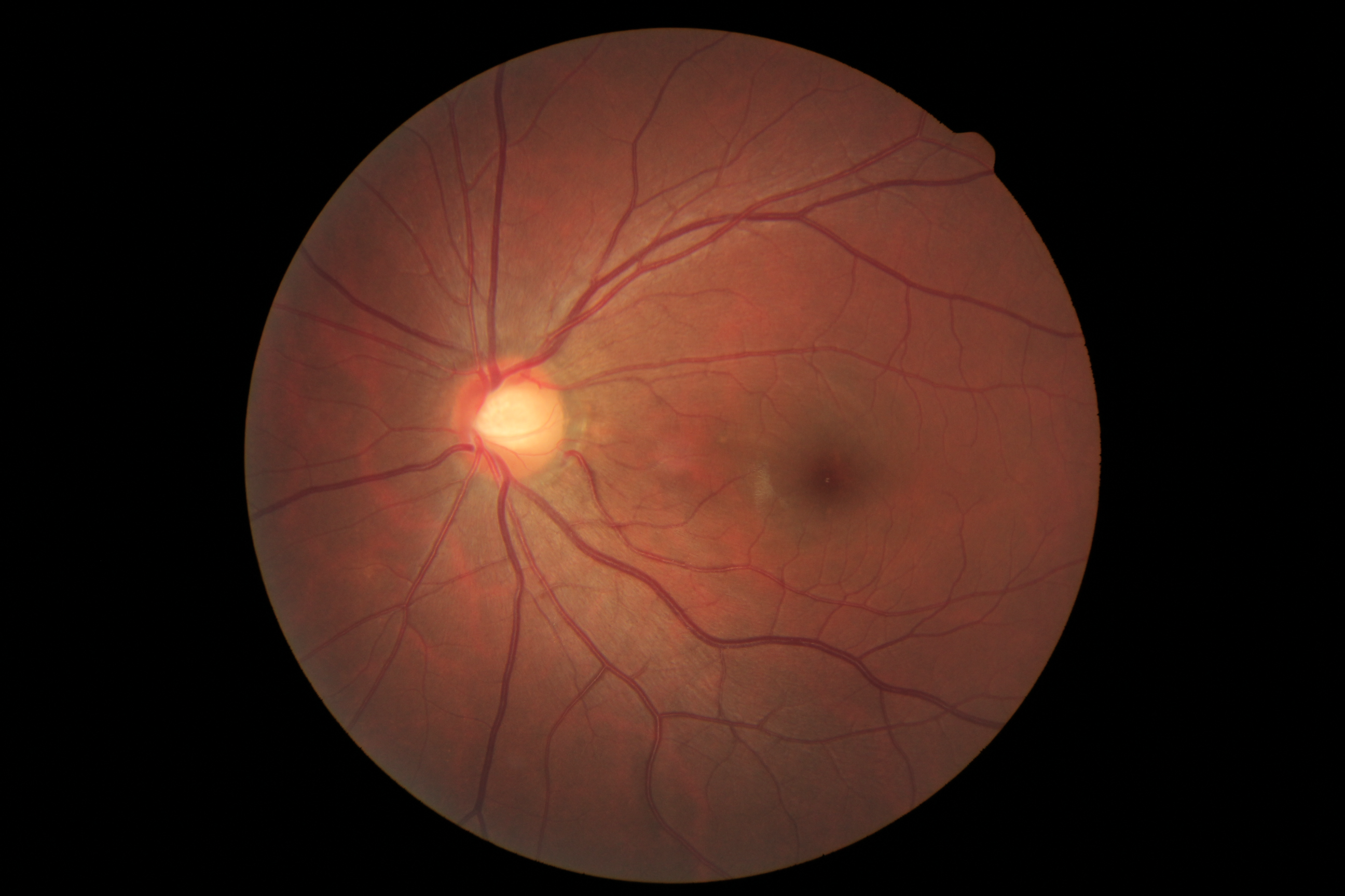 Cataract Detection 100 pics each Object Detection Dataset by Cataract ...