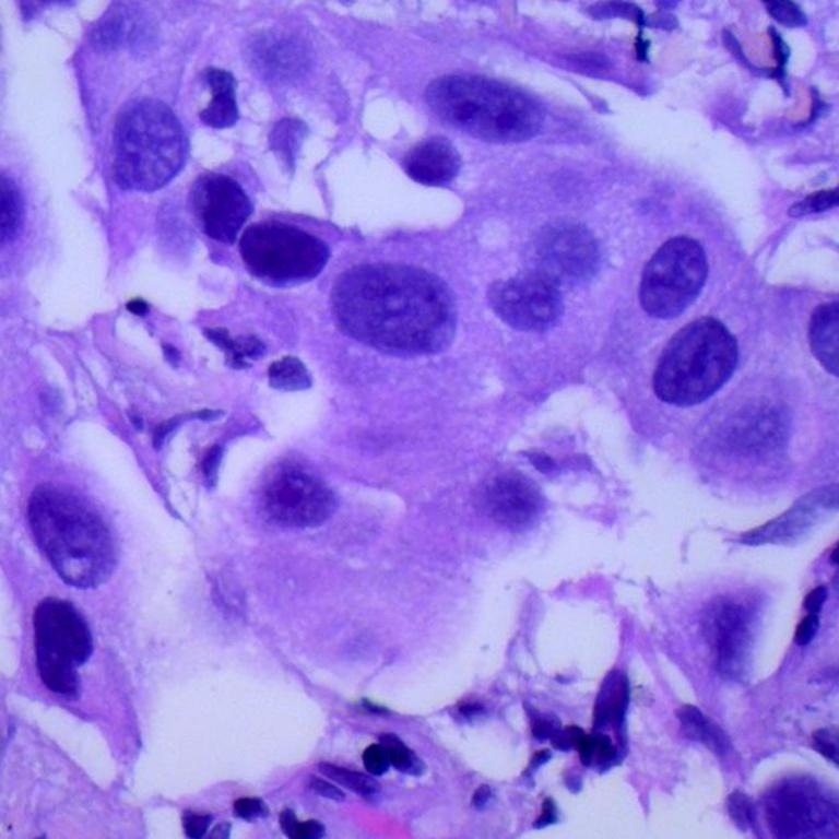 cancer Object Detection Model by cancergrades