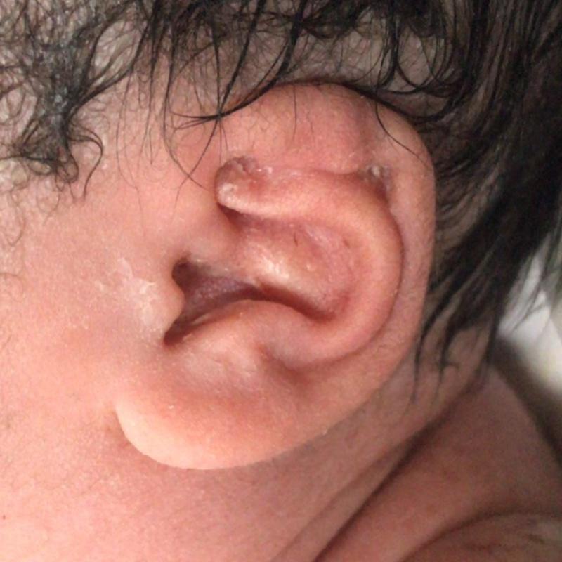 ear deformities Object Detection Dataset and Pre-Trained Model by Dimas ...