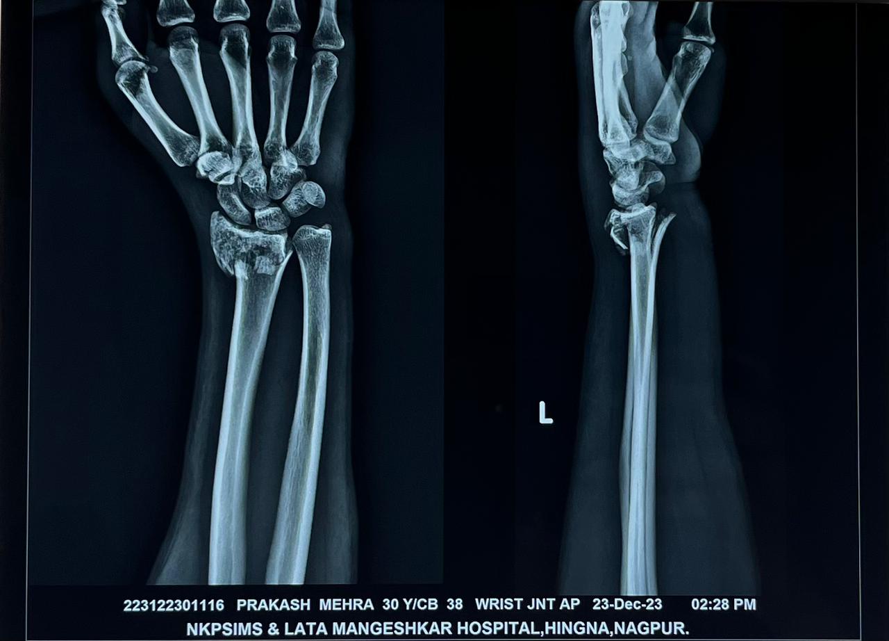 wrist fracture Object Detection Dataset by wound