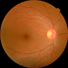 Detection Of Diabetic Retinopathy Using Machine Learning Classification ...