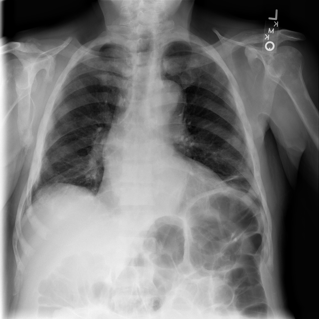 X-ray Disease Diagnosis Classification Model by Science Fair