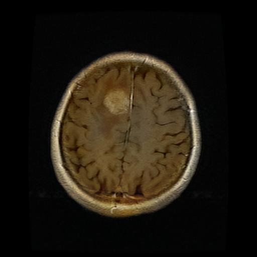 Live Brain Surgery Object Detection Model by OpenVision