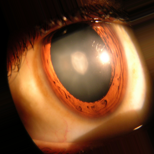 Cataract Object Detection Dataset by Yolo