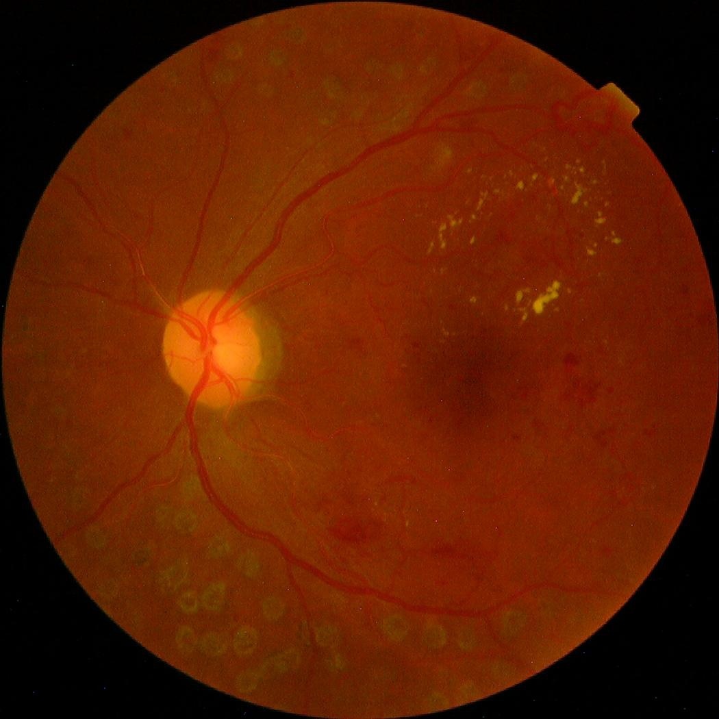 DR disease Classification Dataset and Pre-Trained Model by 001