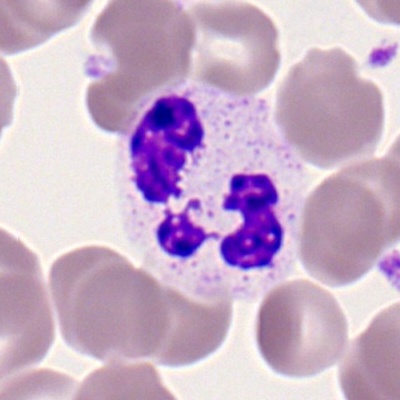 Blood Cell Cancer Detection - Roboflow Universe