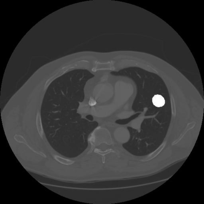 lung-cancer-detect Object Detection Dataset by whiteblood