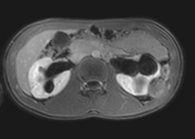 kidney Semantic Segmentation Model by liver segmentation
