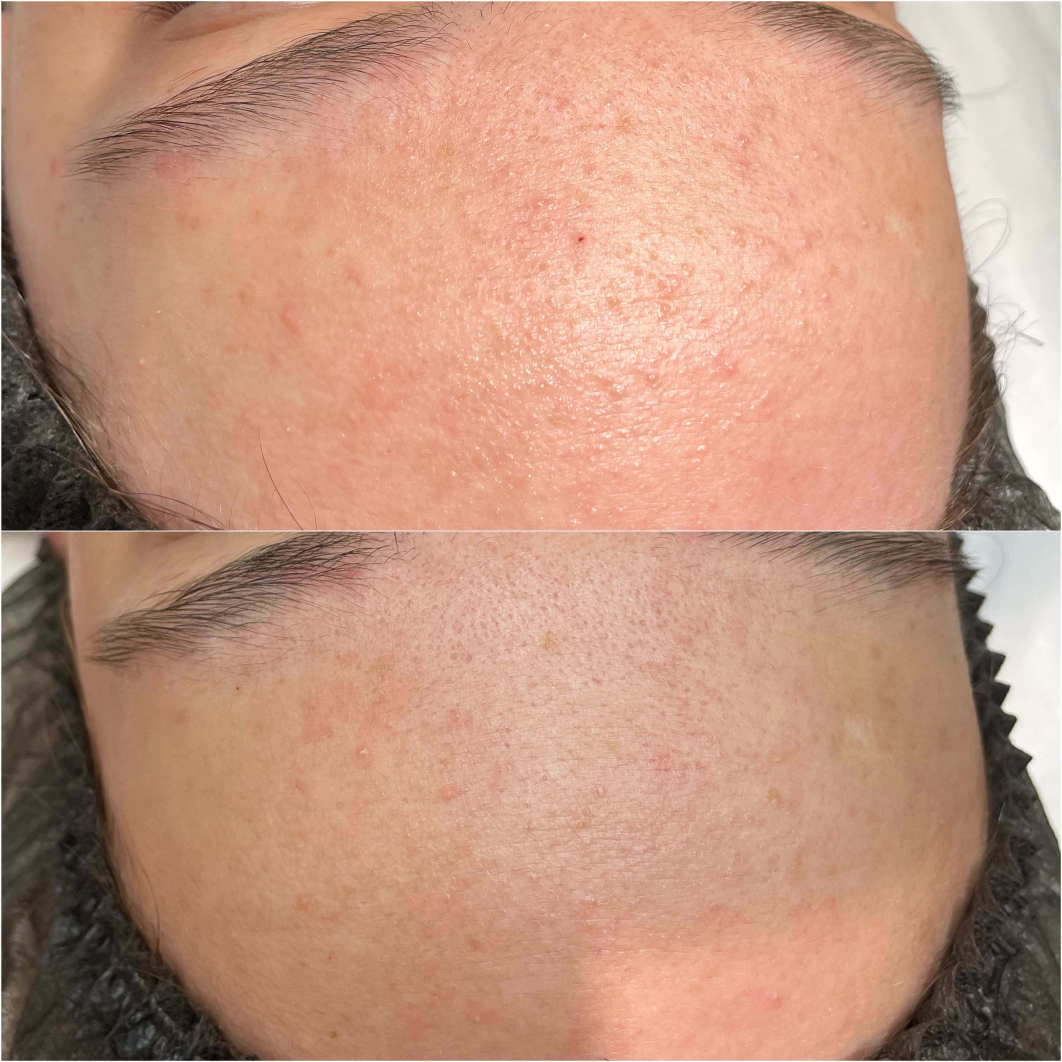 Acne Object Detection Dataset by ELBRUS