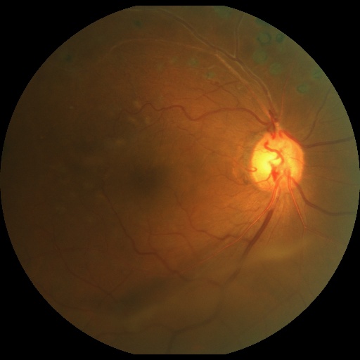 Diabetic Retinopathy Classification Model by DR Classification