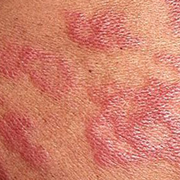 LEPROSY DATASET YOLOv5 Object Detection Dataset and Pre-Trained Model by Mapua University