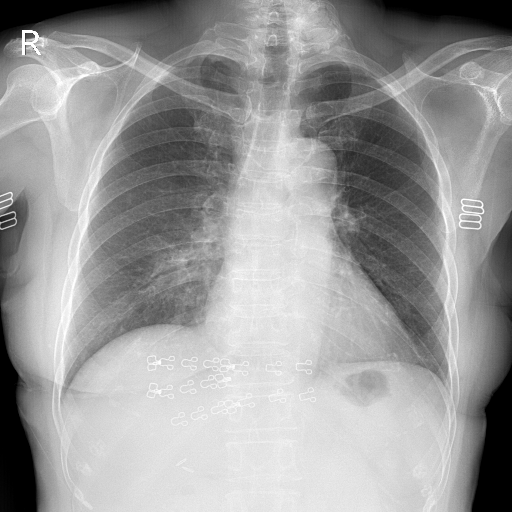 Vinbigdata Object Detection Dataset by Minohealth AI