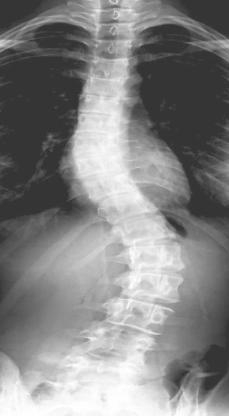 Spine Region Instance Segmentation Dataset by ESCONET PROYECT