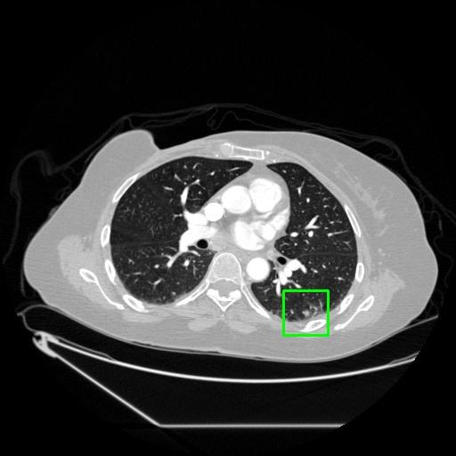 Lung cancer Detection Object Detection Model by murad-hassis-1jel5