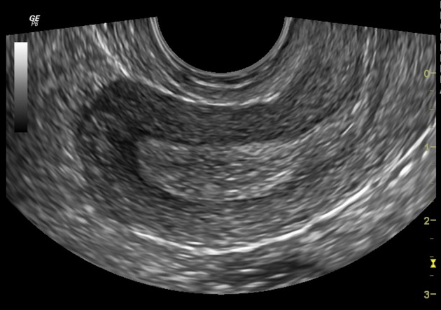 Uterine Fibroid Object Detection Dataset By Capstoneproject