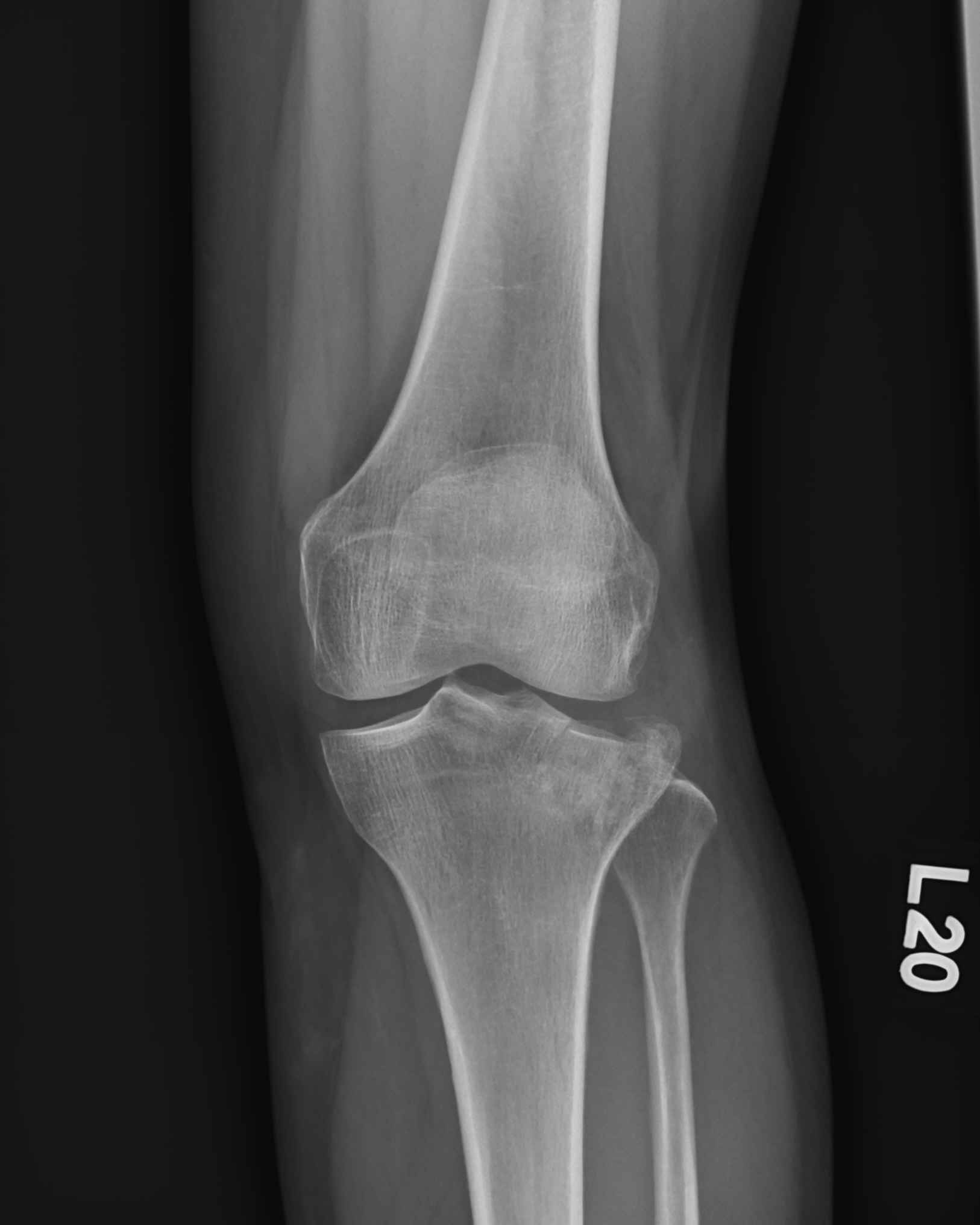 ankle surgery detection Object Detection Dataset by simon165