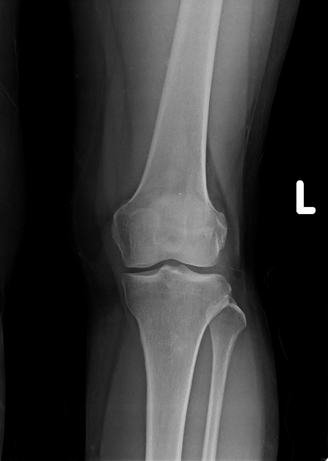 Tibial Plateau Object Detection Dataset by simon165