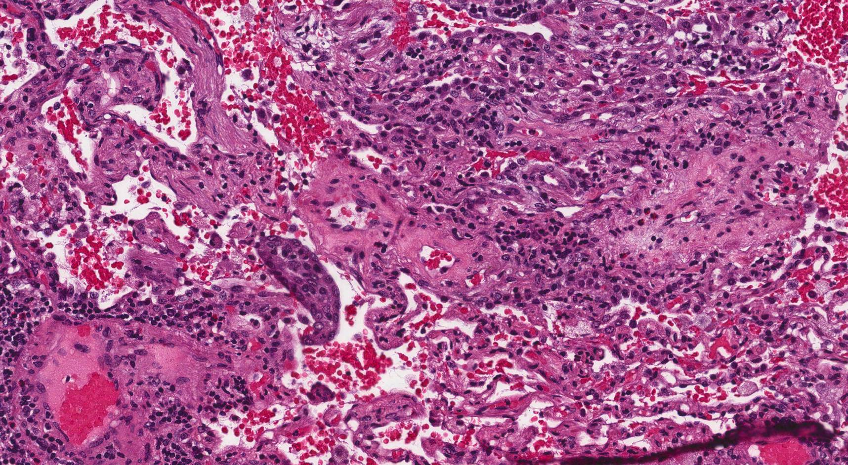 Lung Cancer Object Detection Object Detection Dataset By Edward Coding