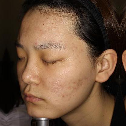 Acne Detection Object Detection Dataset by Facial Detection