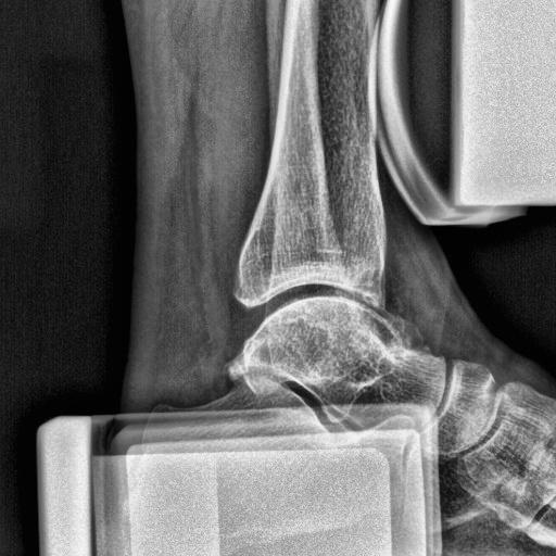 Ankle Sprain Object Detection Model by YOLO